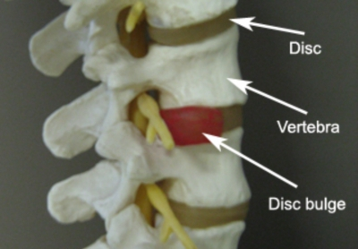 Treatment for Disc Prolapse or PIVD | ReLiva Physiotherapy