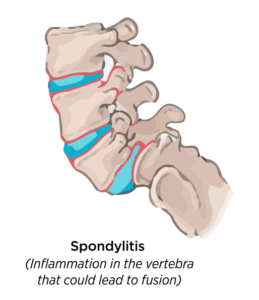Understanding Spondylosis & Spondylitis | ReLiva Physiotherapy & Rehab