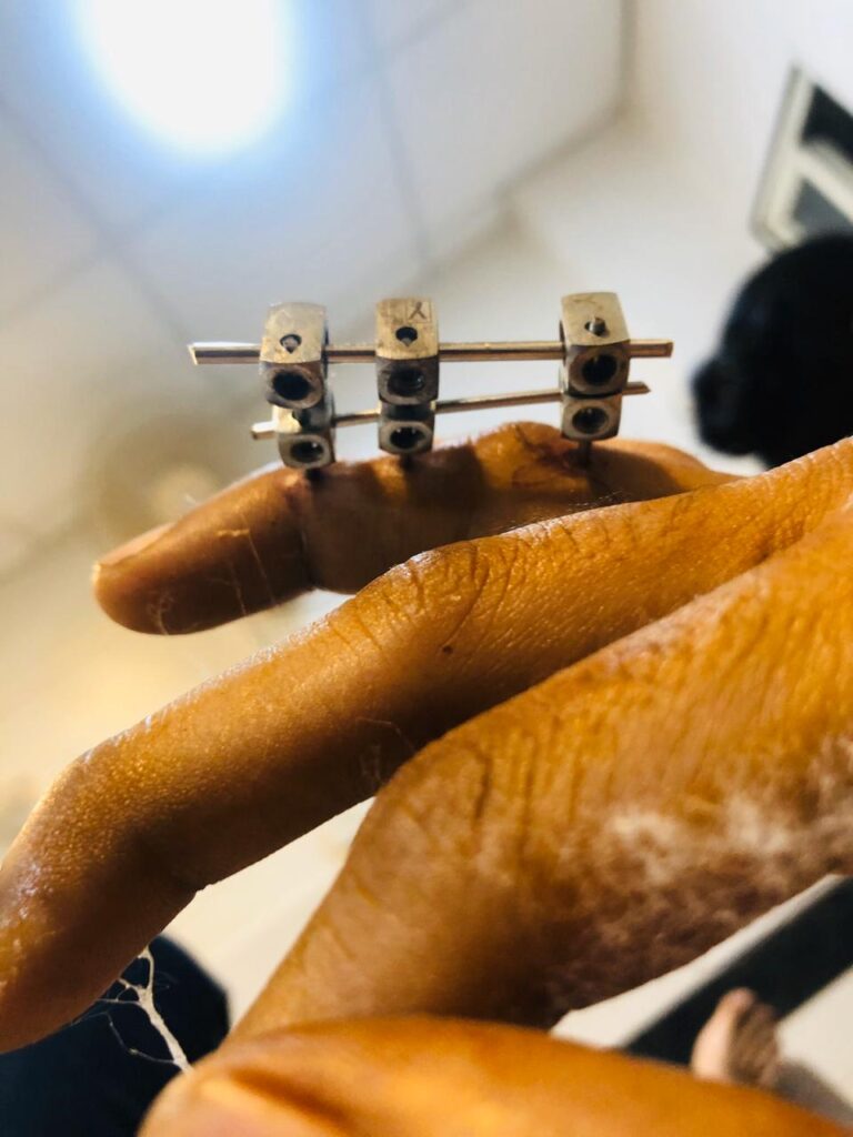 Online Physiotherapy: Fractured Finger, ReLiva Physiotherapy